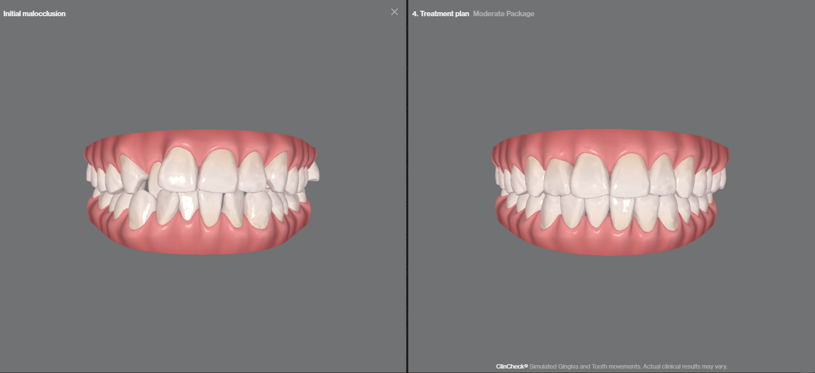 Treatment plan simulation - Best Bangkok Dental Clinic | Best Dentist ...