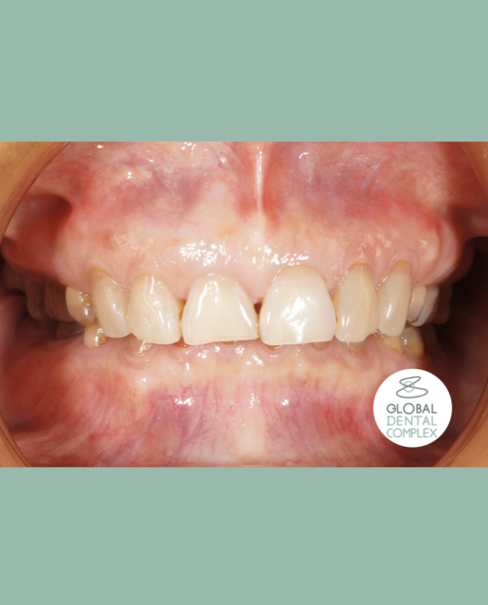 Smile Makeover With Invisalign Crowns Digital Smile Design