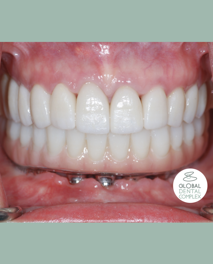 Smile Makeover & Full Mouth Dental Implants Smile Makeover & Full Mouth Dental Implants