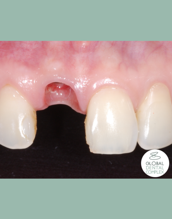 One Day Immediate Anterior Implant