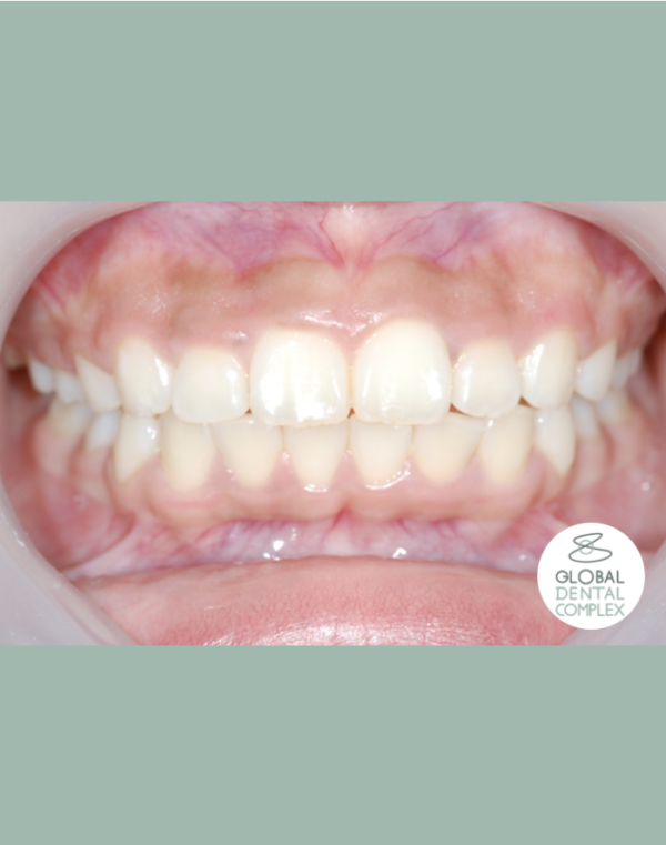 Upper teeth protrusion (Buck tooth) with braces treatment, Bangkok