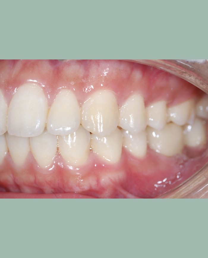 Uprighting Impacted Bilateral Lower Back Teeth (Molars)