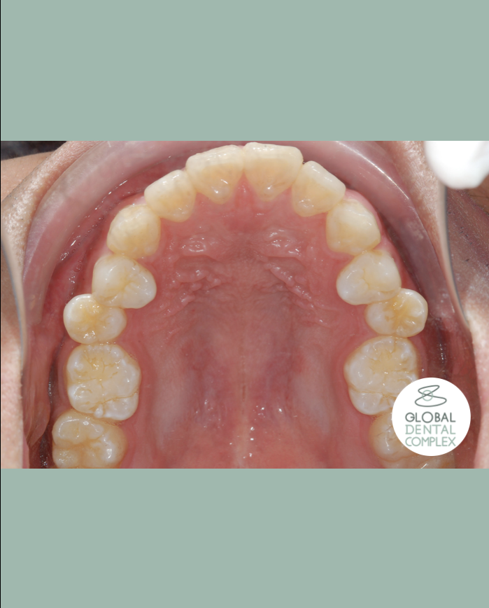 Uprighting Impacted Bilateral Lower Back Teeth (Molars)